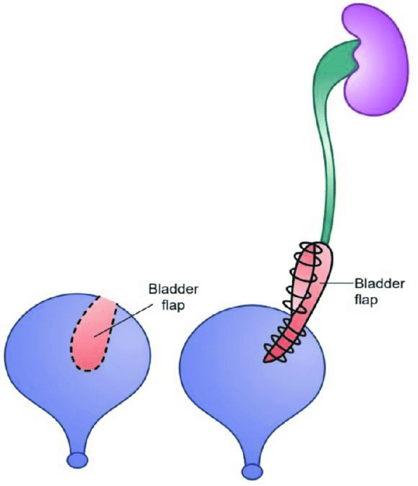 Laparoscopic recosntructive surgery - NKPC Hospital